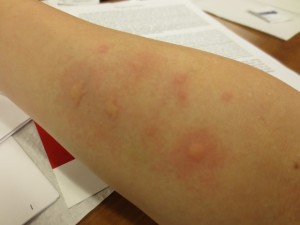 Top 10 Odd Allergies in Humans